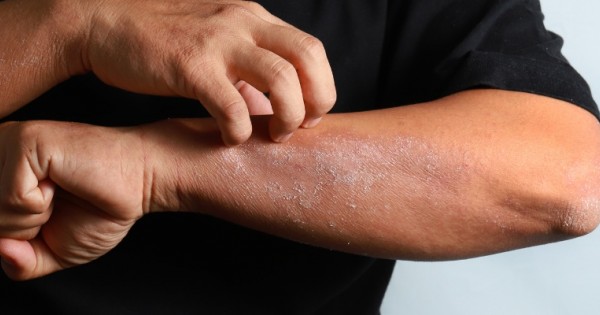 ᐉ Eczéma: Comment le Reconnaître et le Traiter Efficacement - Benepura.fr